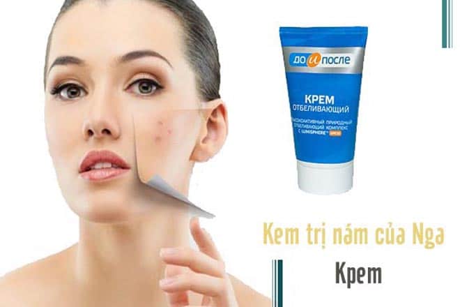 Kem trị nám Kpem của Nga đặc trị nám da vô cùng hiệu quả